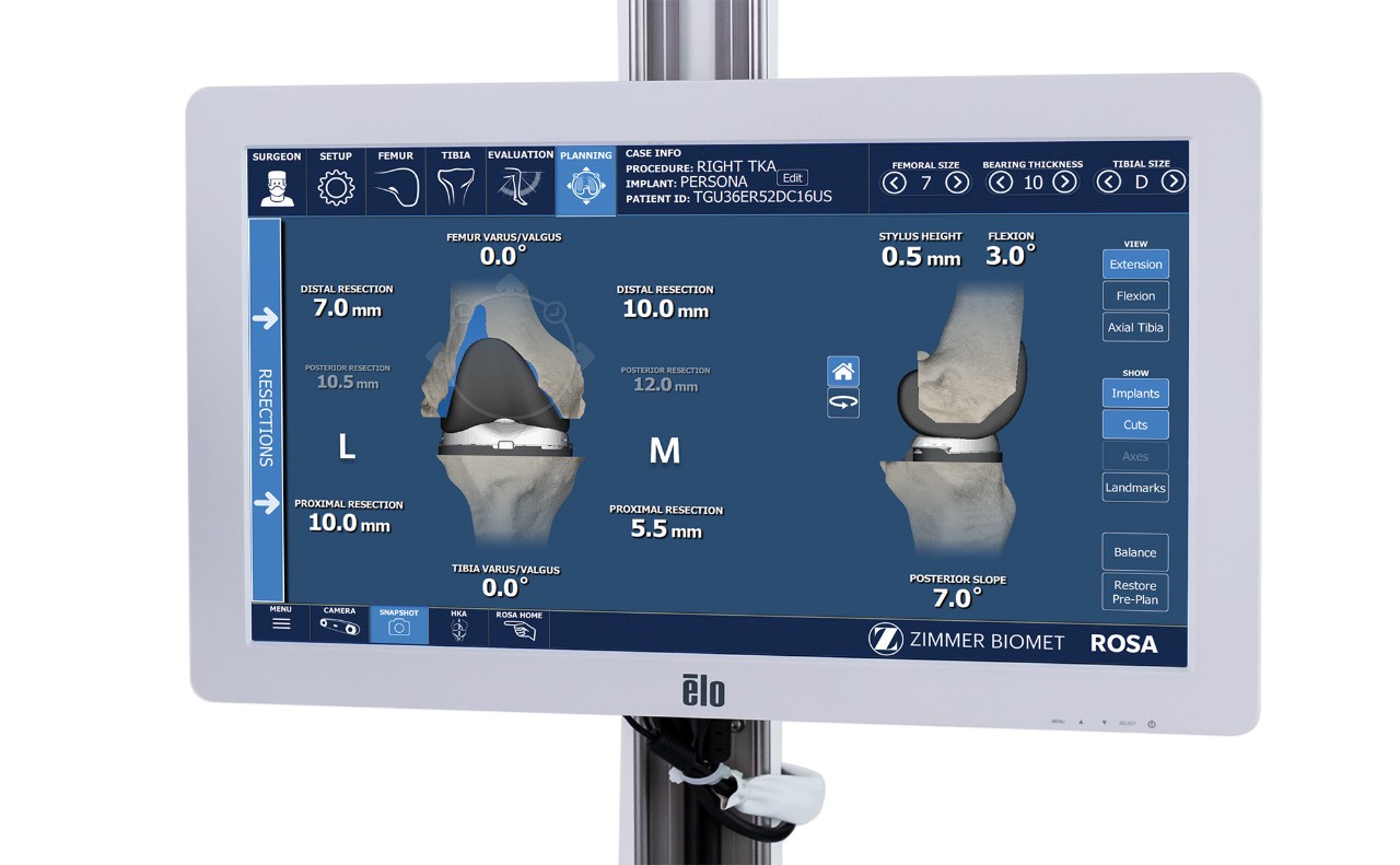 Total Knee Replacement